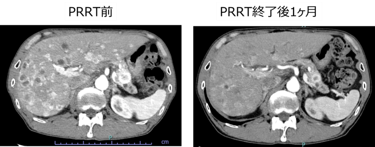 市民のためのがん治療の会